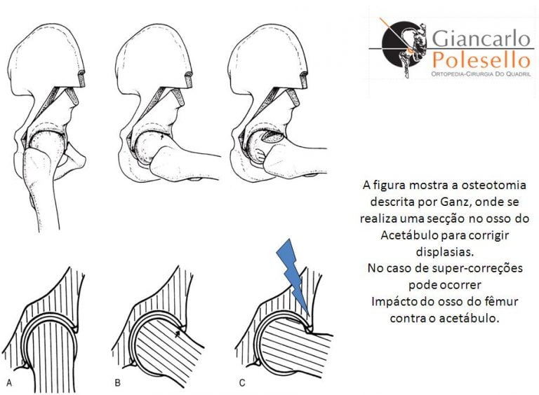 Impacto fêmoro-acetabular | Cirurgia, tratamento e reabilitação de quadril