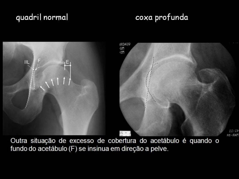 A radiologia do quadril - Cirurgia, tratamento e reabilitação do quadril