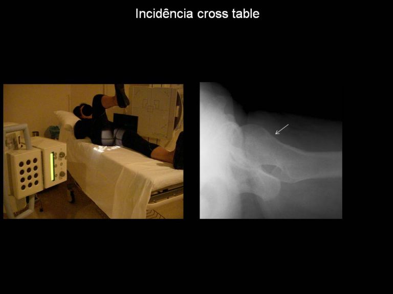 Radiografias - Cirurgia do Quadril