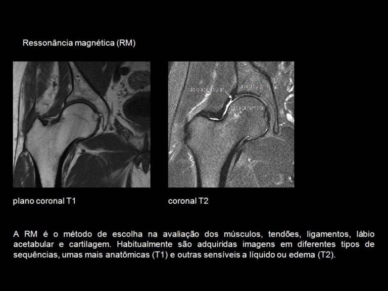 A radiologia do quadril - Cirurgia, tratamento e reabilitação do quadril