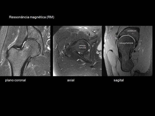 A radiologia do quadril - Cirurgia, tratamento e reabilitação do quadril