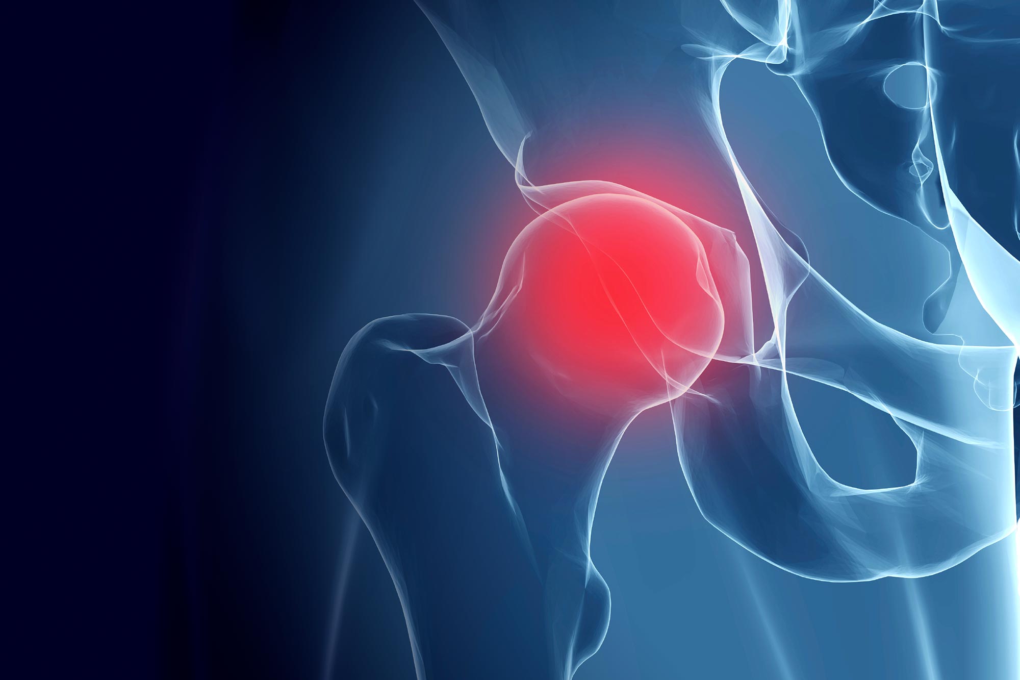 Artroplastia do quadril: o que você precisa saber sobre? - Cirurgia do ...